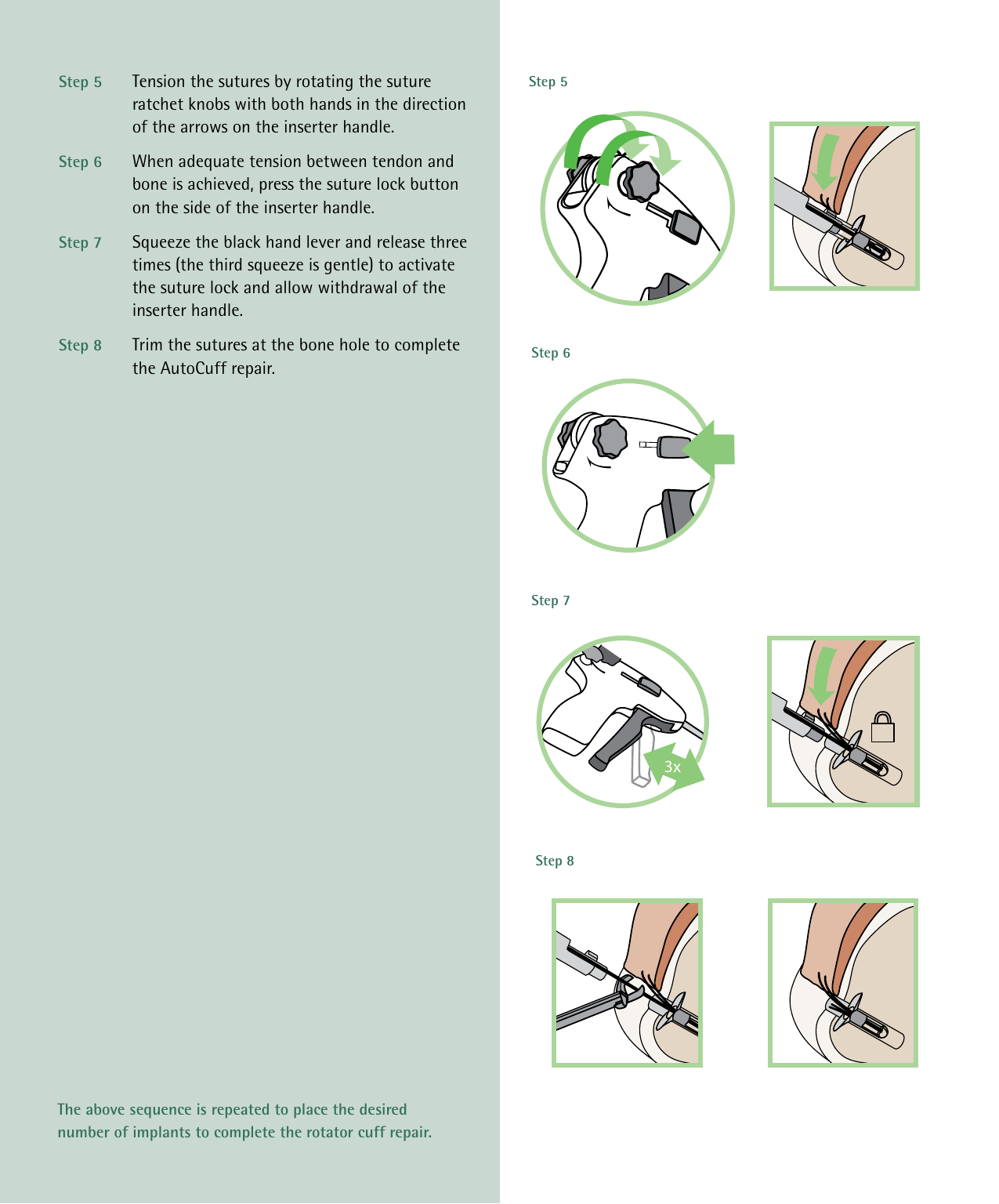 Arthrocare Auto Cuff Technique Guide