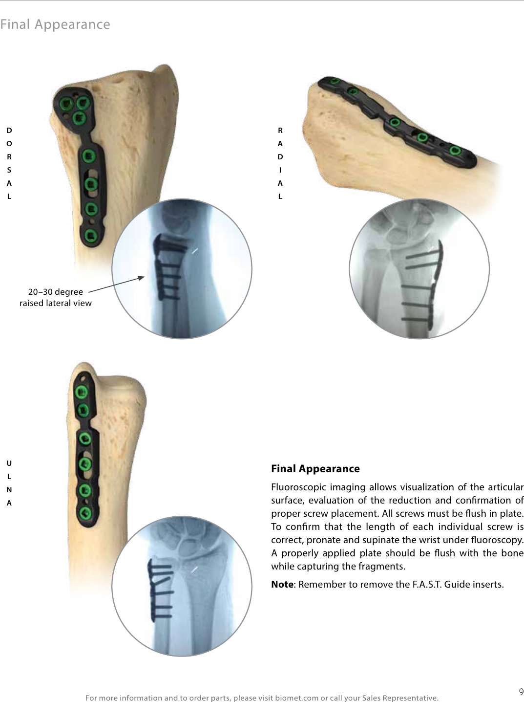 DVR Wrist Plates Featuring E PAK Surgical Technique