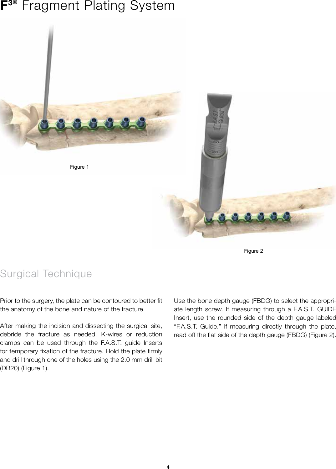 F3 Fragment Surgical Technique
