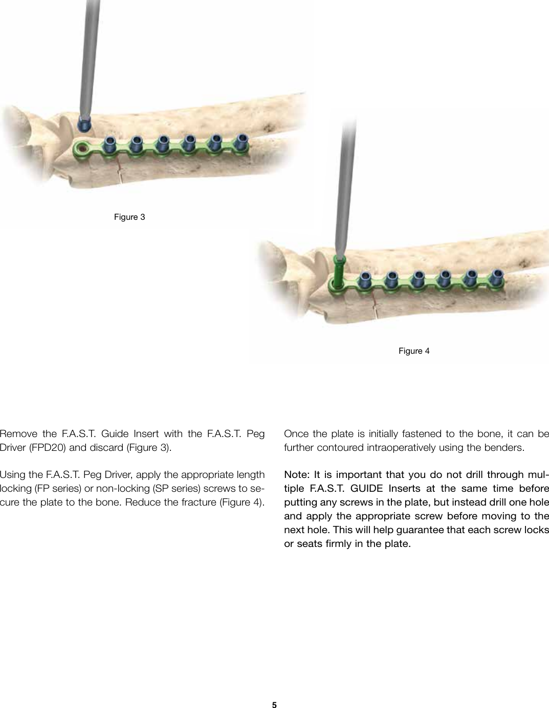 F3 Fragment Surgical Technique
