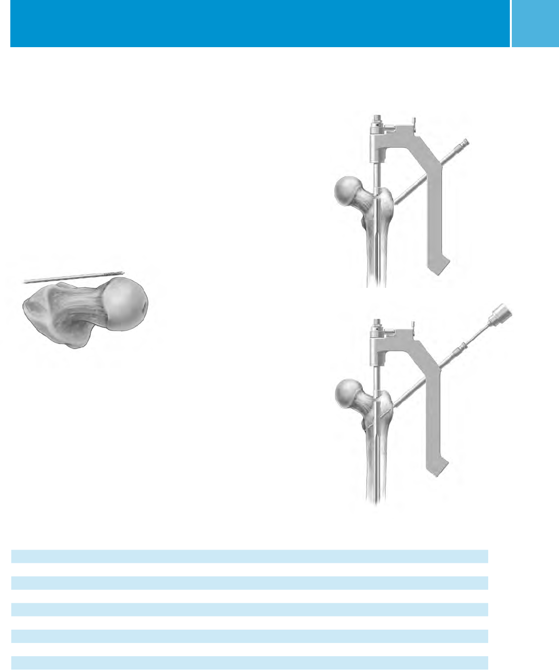 M/DN® Femoral Interlocking & Recon Nail Intramedullary Fixation ...