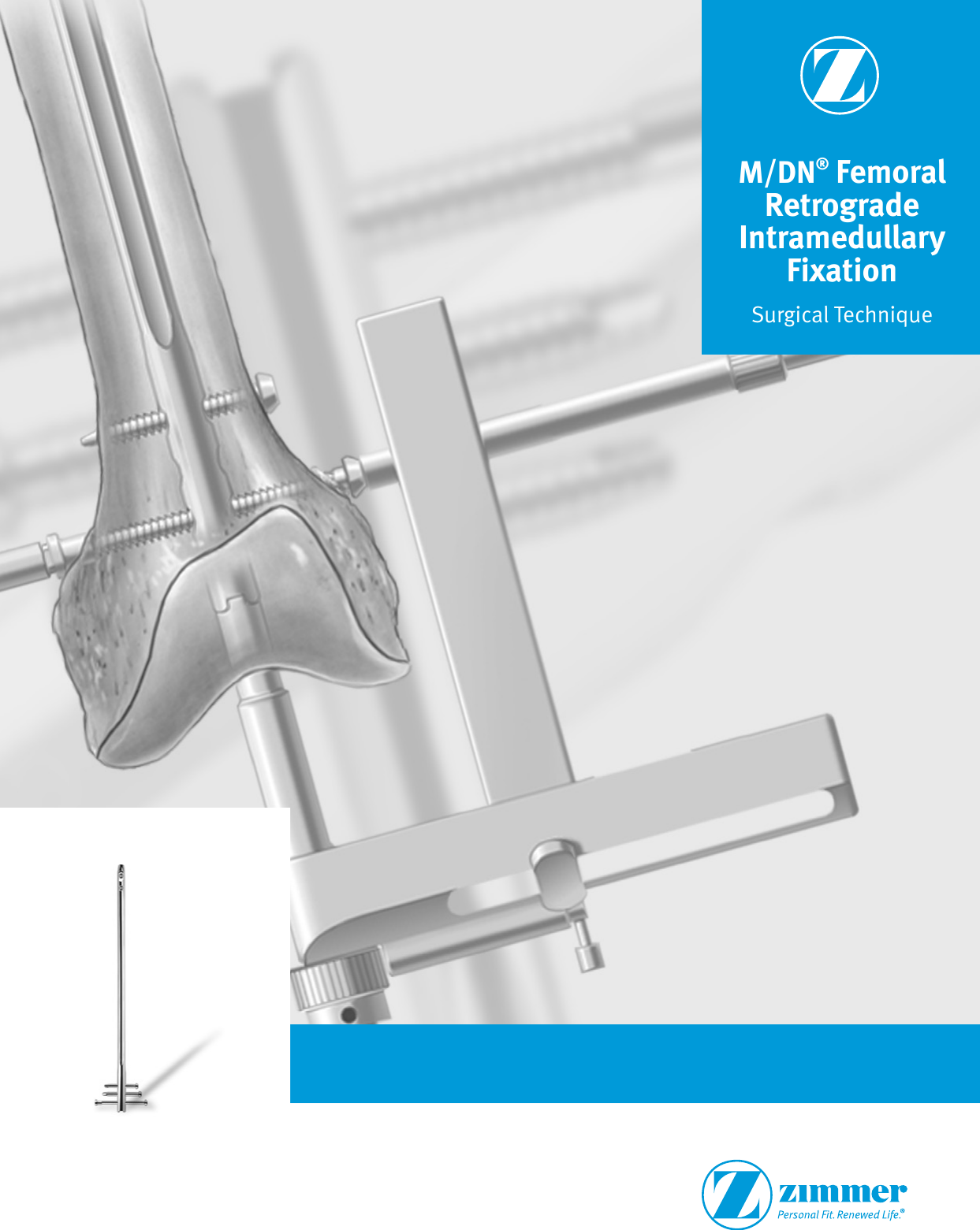 M/DN® Femoral Retrograde Intramedullary Fixation Surgical Technique Mdn