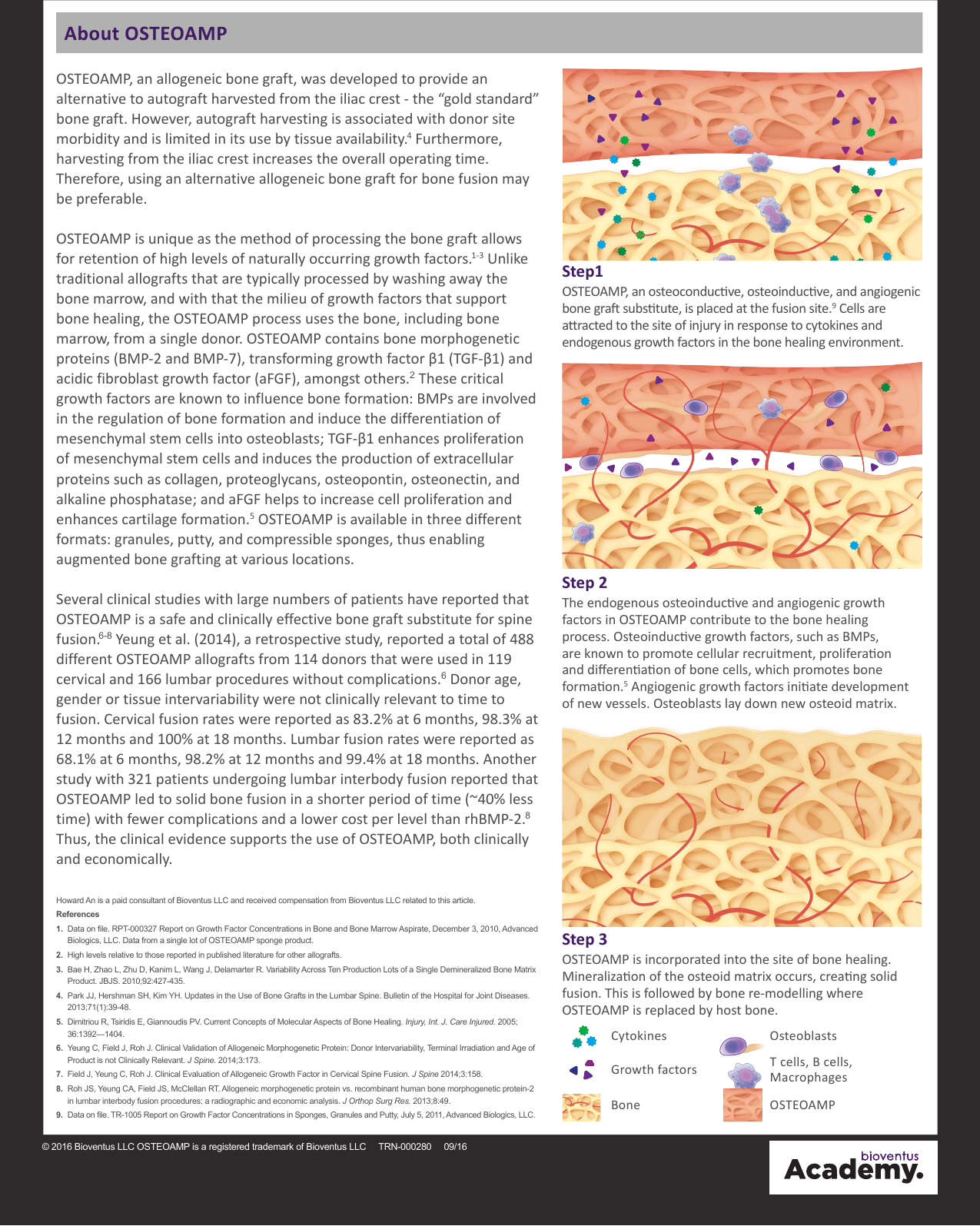 OSTEOAMP Case Report Posterolateral Lumbar Fusion