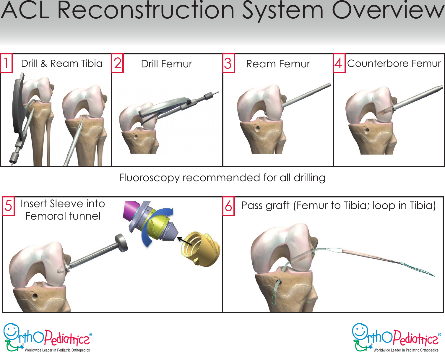 SA 1008 01 02 ACL Reconstruction System Overview