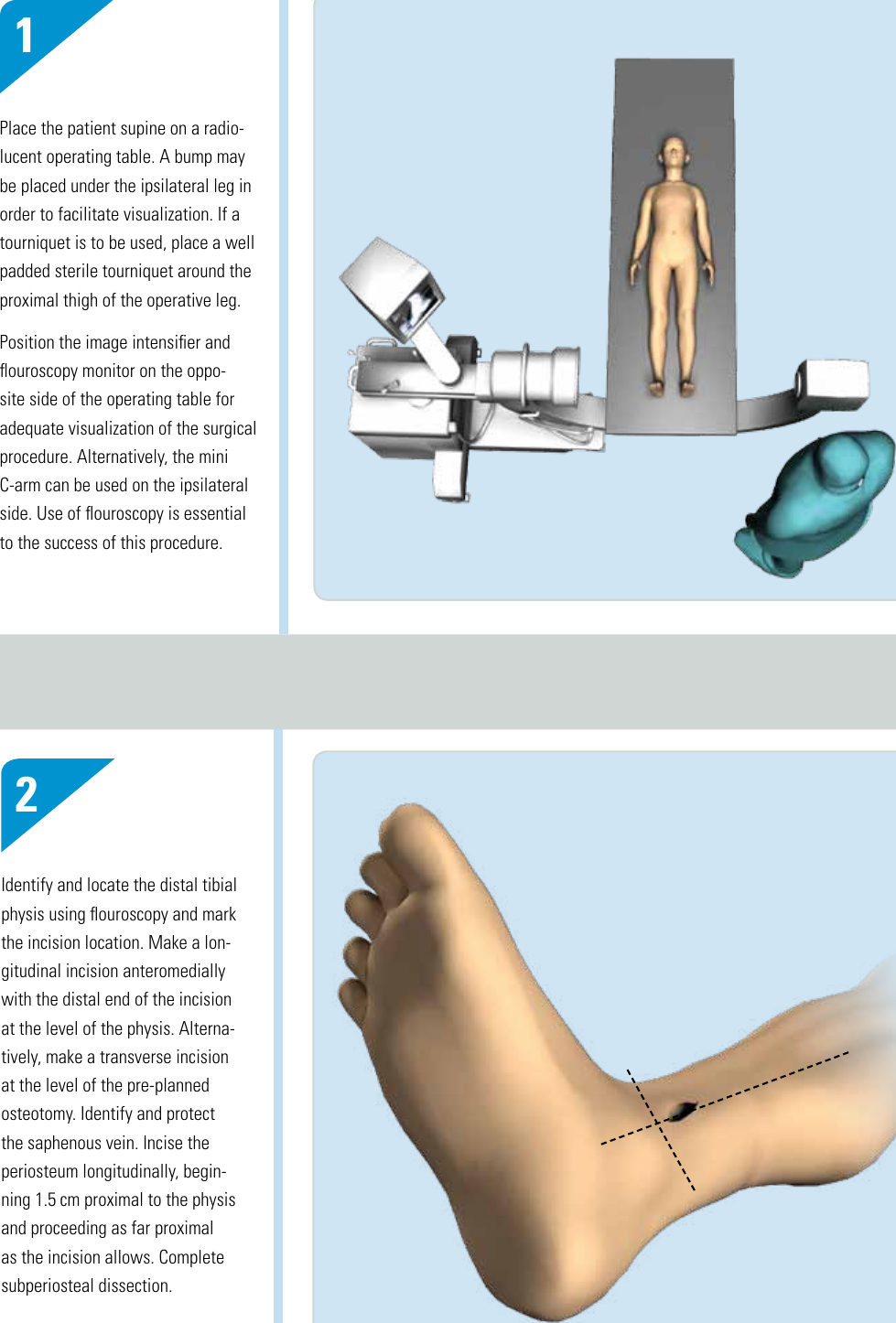 Tibia Surgical Technique