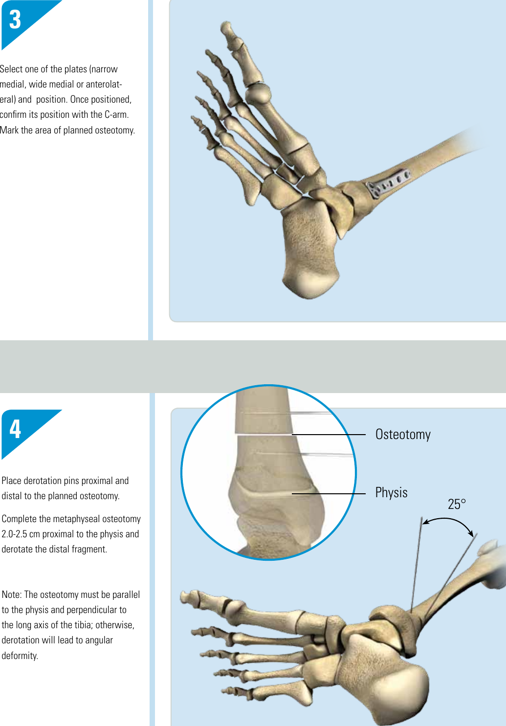 Tibia Surgical Technique