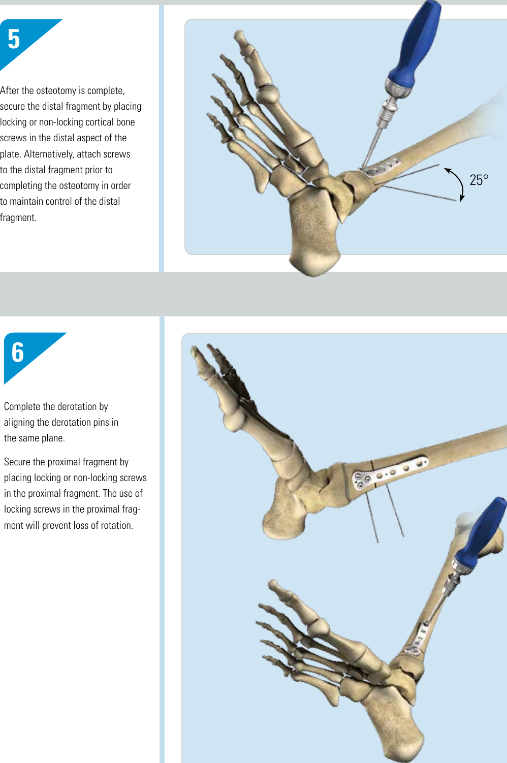 Tibia Surgical Technique