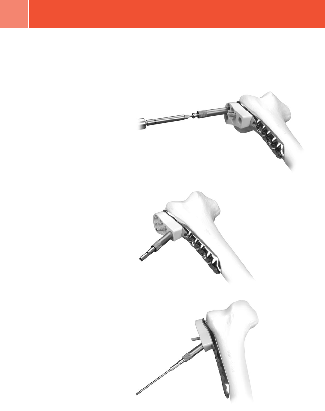 Zimmer Periarticular Distal Femoral Locking Plate Surgical Technique